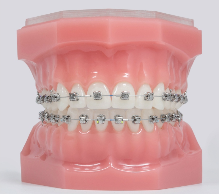 Damon Braces London